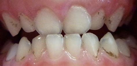 Understanding Dental Discolorations And Stain Removal Flashcards Quizlet