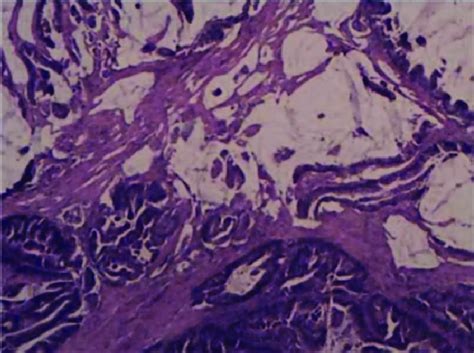 Pathology Slide Showing Well Differentiated Mucinous Adenocarcinoma
