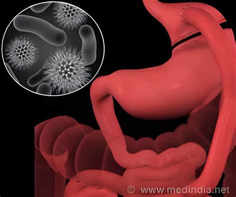 Patients Enjoy Quality Of Life 10 Years After Esophagectomy With