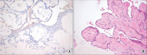 A Microphotograph Of Immunohistochemical Stain The Portion Of