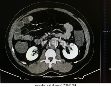 78 Aortic Dissection X Ray Images Stock Photos 3D Objects Vectors Shutterstock