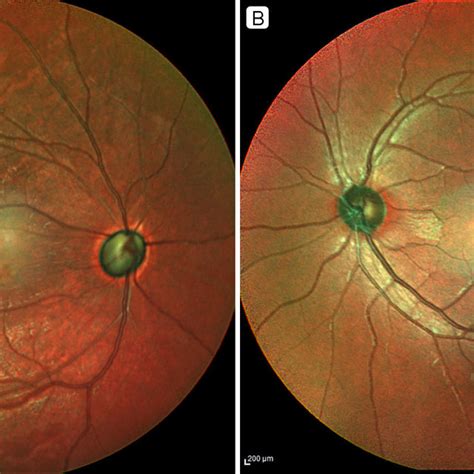 A Gonioscopy Of The Right Eye Showing 4 Posterior Trabecular Meshwork Download Scientific