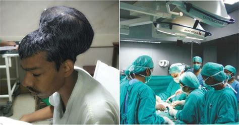 Mumbai Doctors Remove World S Largest Brain Tumour Weighing Kg