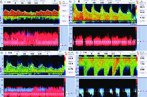 Local Hemodynamics In A Patient With Carotid Occlusion Before And After
