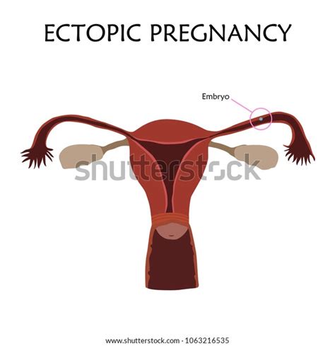Ectopic Pregnancy Fertilized Egg Uterus Womb Stock Vector Royalty Free