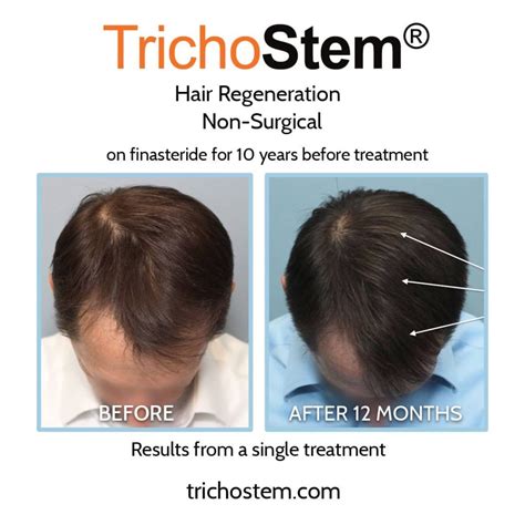 Why Is Finasteride Not Working Dr Prasad Blog