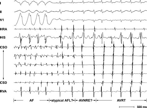 Accessory Pathway Conduction At Madalyn Hartley Blog