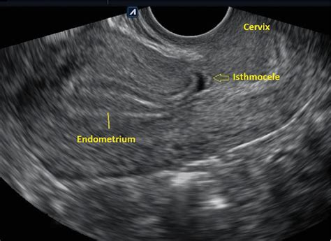 Figure 14 From Sonographic Assessment Of Isthmocele And Its Obstetric