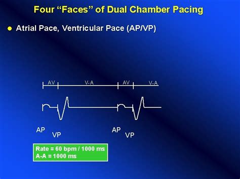 Pacemaker Timing And Intervals Objectives L L L