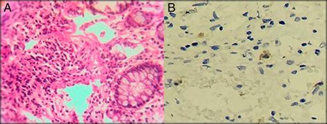 A Hematoxylin And Eosin Stain Of Ampulla Biopsy Showing Storiform