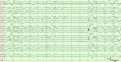 Eeg0006
