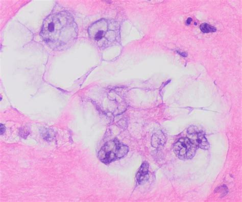 Mirvetuximab Soravtansine Gynx Approved For Frα Positive Platinum