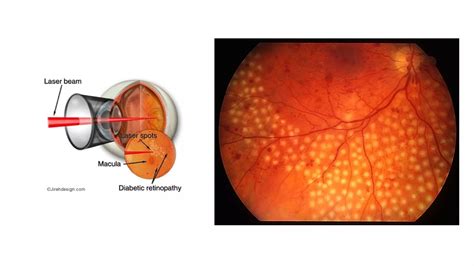 Retinal Detachment Ophthalmology Ppt