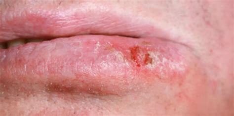 Lip Cancer Preliminary Stages Symptoms And Treatment Curaprox