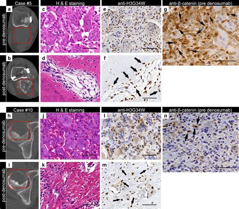 Nuclear Positivity Of β Catenin In Gctb Scs Predicts Intra Tumoral Bone