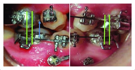 Super Class I Molar Relationships At Both Sides After Applying 1 Mm
