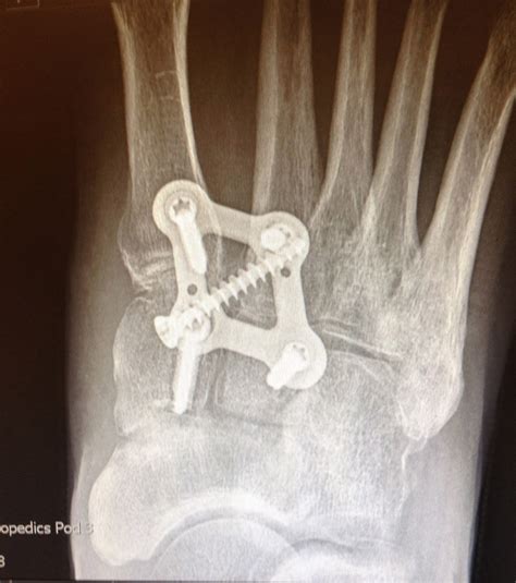 After Lisfranc Surgery 12 Weeks Post Lisfranc Surgery X Rays