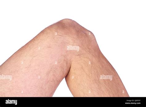 Pdf] Apophysitis Of The Tibial Tuberosity Osgood Schlatter 42 Off