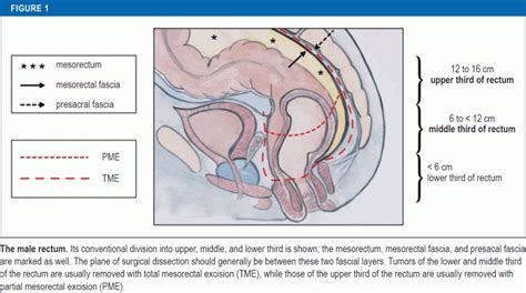 Multimodal Treatment Of Rectal Cancer 22082022
