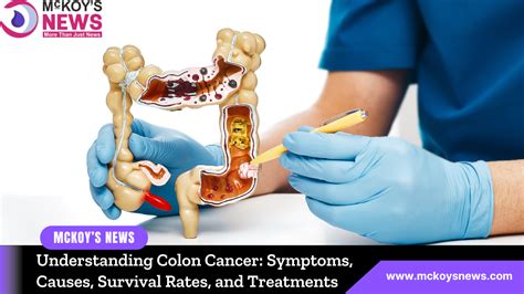 Understanding Colon Cancer Symptoms Causes Survival Rates And