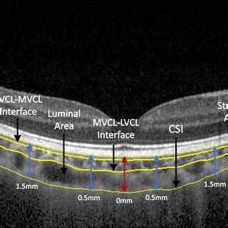 Choroidal Vascularity Index CVI And Choroidal Thickness Were Measured