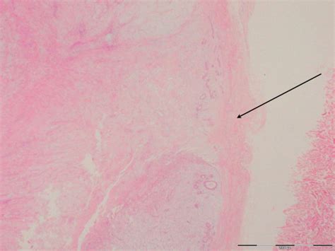 Phyllodes Tumor Border Hande Staining ×1 25 Magnification This Section Download Scientific