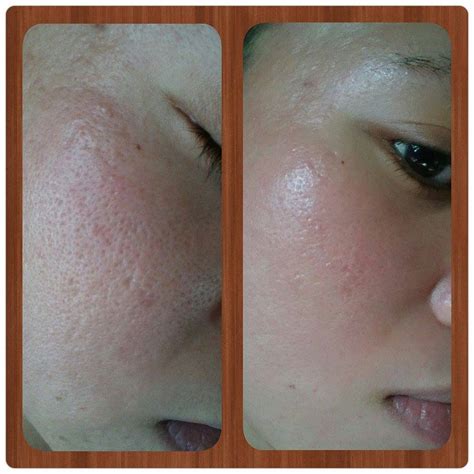 Professional Grade Derma Roller And Micro Needling System