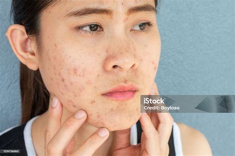 그녀의 얼굴에 여드름 염증 의 문제가걱정 여자의 닫습니다 문제에 대한 스톡 사진 및 기타 이미지 문제 아시아인 여드름 Istock