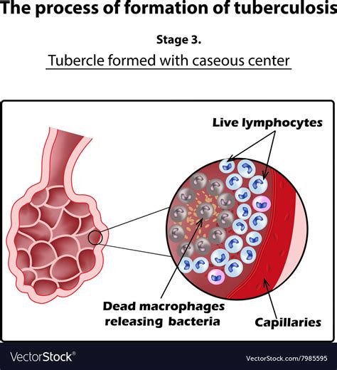 Development Of Tuberculosis Stage 3 Royalty Free Vector