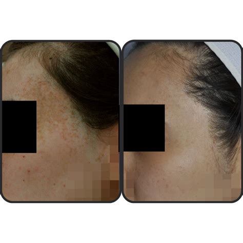 Helios 785 Pico — Laseroptek