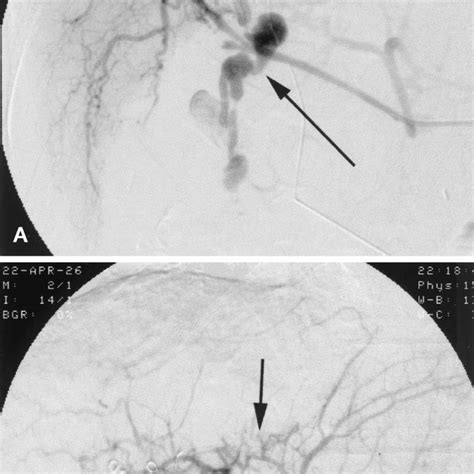 A 75 Year Old Male Underwent Extended Cholecystectomy For Carcinoma Of
