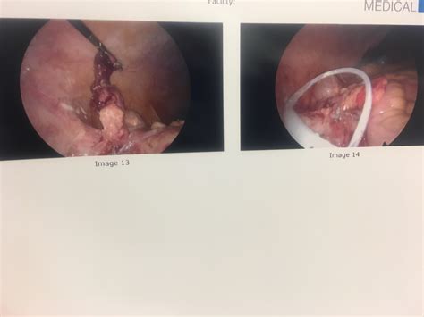 Interior Shots Of My Ruptured Appendix And Inserted Drain Rmedicalgore