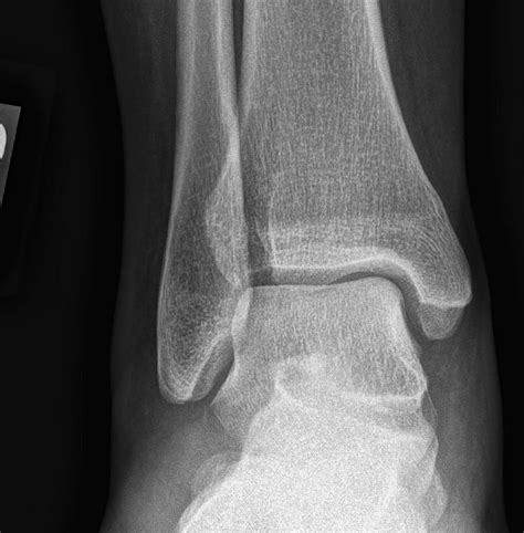Avulsion