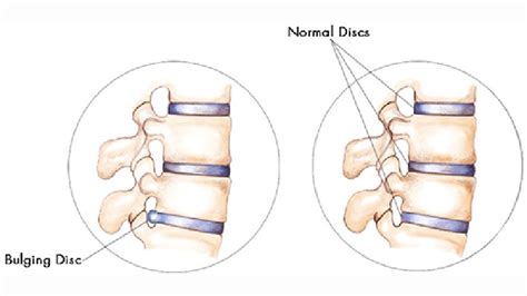 12 Causes Of Bulging Discs Entirely Health