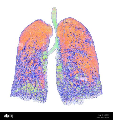 Usual Interstitial Pneumonia Coloured 3d Computed Tomography Ct Scan