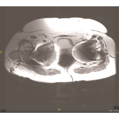 A Per Operative View Of The Rice Like Body Cyst The Rice Like Body