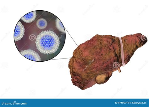Liver With Hepatitis C Infection Stock Illustration Illustration Of