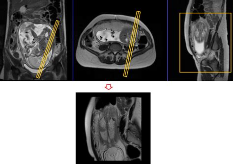 Fetal Mri Spine Scan Protocol And Planning