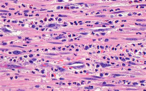 Acute Appendicitis Light Micrograph Stock Image C060 2670
