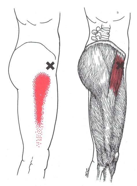 Tensor Fasciae Latae The Trigger Point Referred Pain Guide