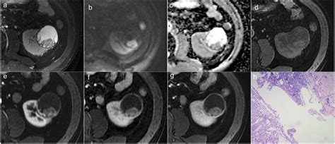 Multiparametric Mri Based Machine Learning Models For The