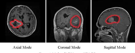 Figure 1 From Tumor Classification Using Block Wise Fine Tuning And