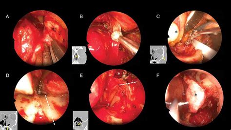 How To Endoscopic Total Maxillectomy Without Facial Skin Incision Open Association Of