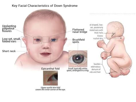Karyotypes And Dysmorphic Features Ppt