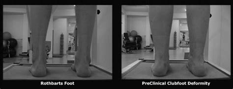 Preclinical Clubfoot Deformity Athlepedia The Athletics Wiki Fandom