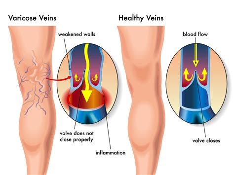 Prevent Varicose Veins Barr Aesthetics