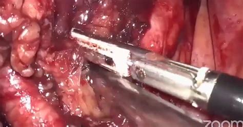 Laparoscopic Radical Cystectomy Bricker Derivation Live Радикальная