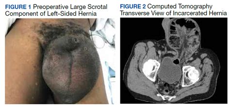 Left Sided Amyand Hernia Case Report And Review Of The Literature Mdedge
