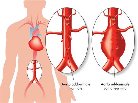 La Aneurisma Cerebral Todo Lo Que Hay Que Saber Aiudo Blog