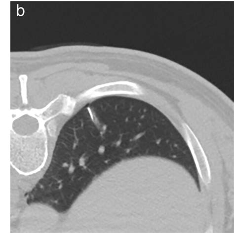 The Dimpling Of Visceral Pleura During Preoperative Ct‐guided Download Scientific Diagram